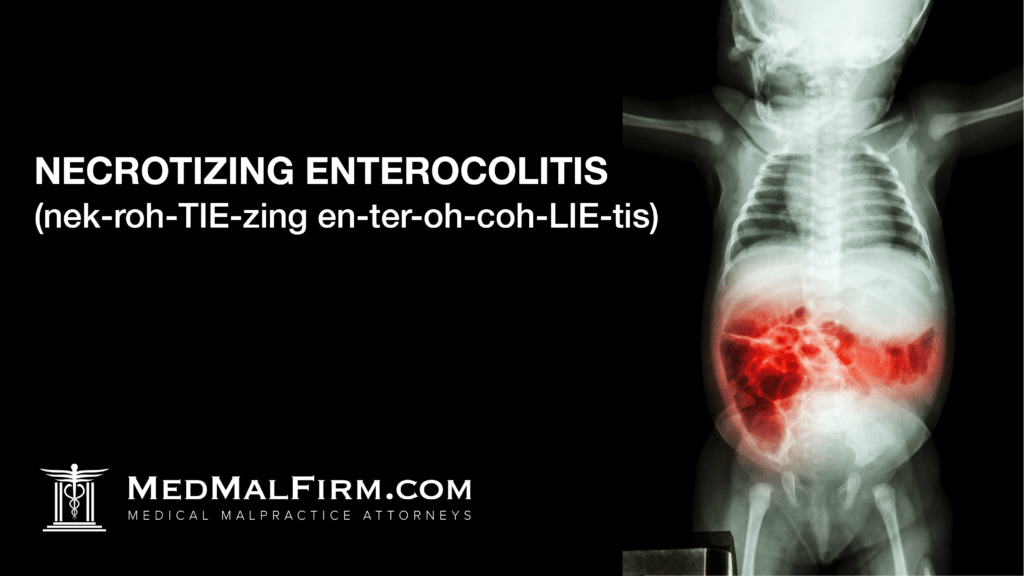 What is Necrotizing Enterocolitis? | MedMalFirm.com