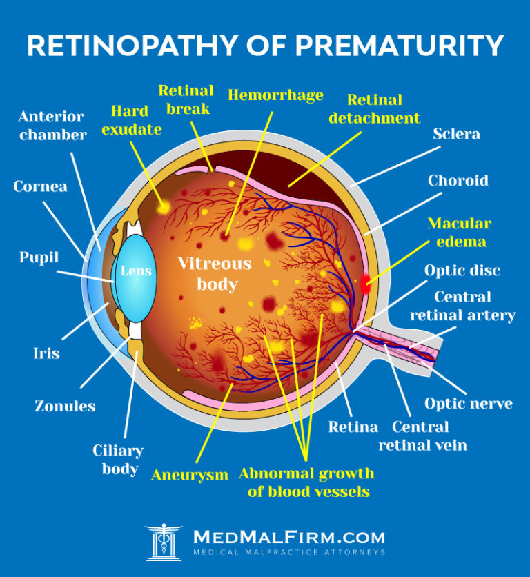 Retinopathy of Prematurity | MedMalFirm.com